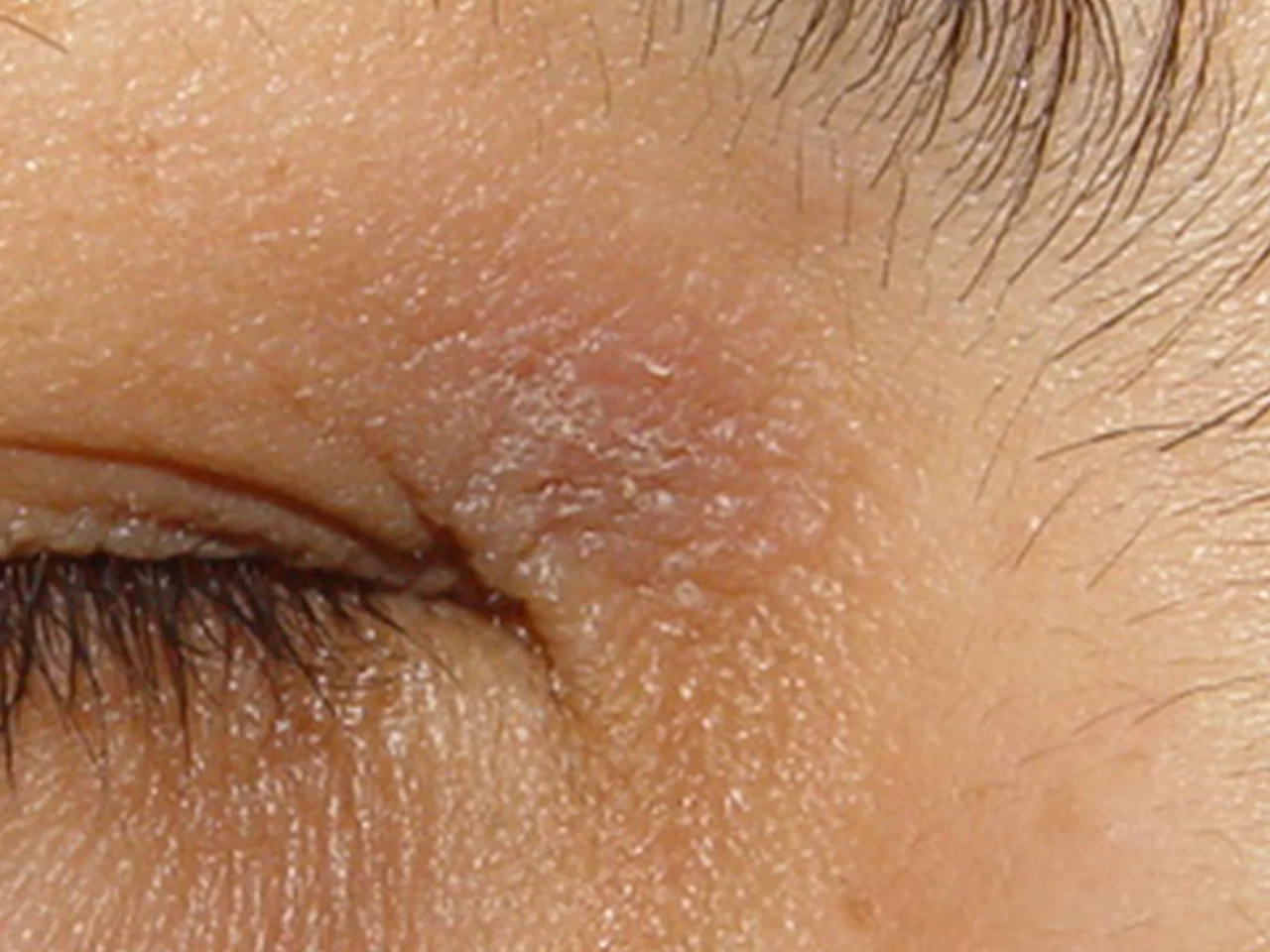 Dermatite De Contato Irritante Nos Pes