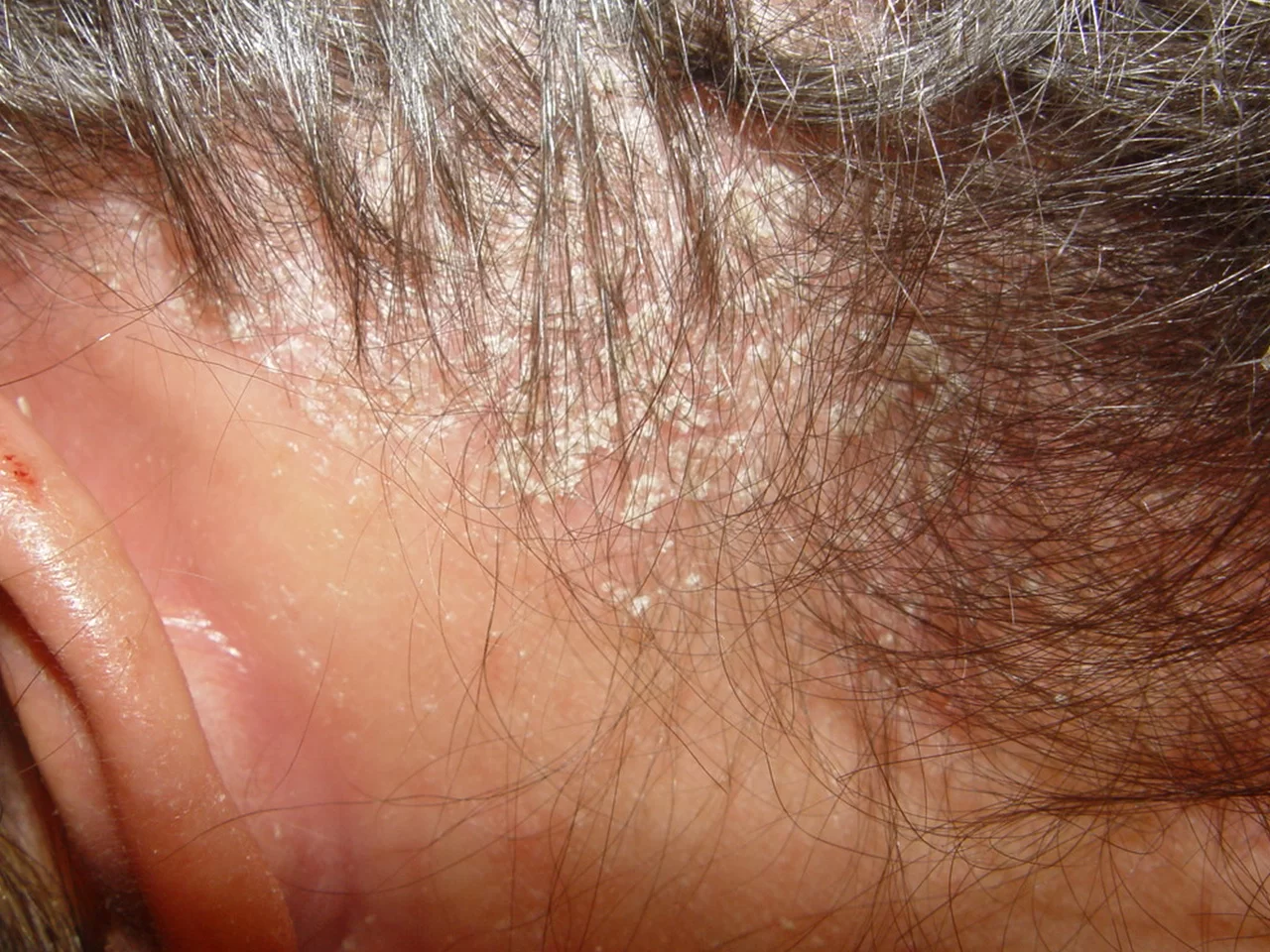 Psoríase: o que é e qual é a causa dessa doença? – Pronto Atendimento ...