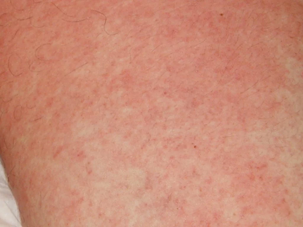 Erupção exantemática por medicamentos – Pronto Atendimento da Pele ...