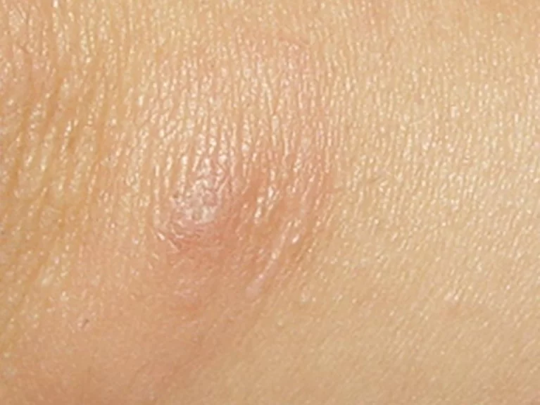 Alergia à picada de inseto: saiba o que causa e como tratar – Pronto ...