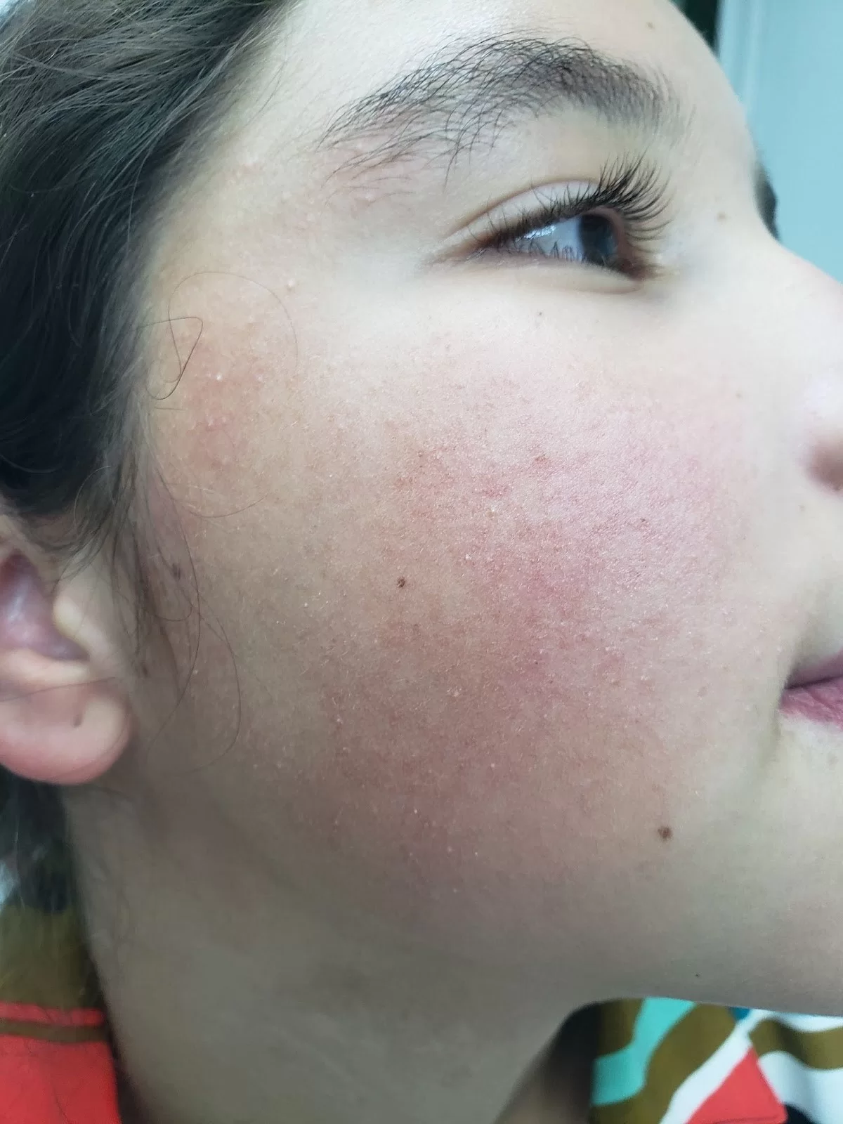 Ceratose pilar: saiba mais sobre os carocinhos na pele que parecem acne ...