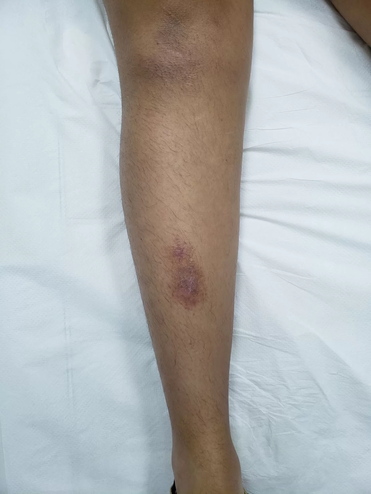 O que é e o que causa eczema numular? – Pronto Atendimento da Pele ...