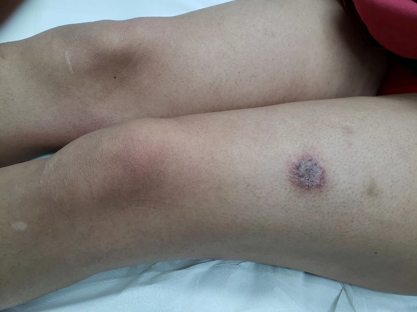 O que é e o que causa eczema numular? – Pronto Atendimento da Pele ...