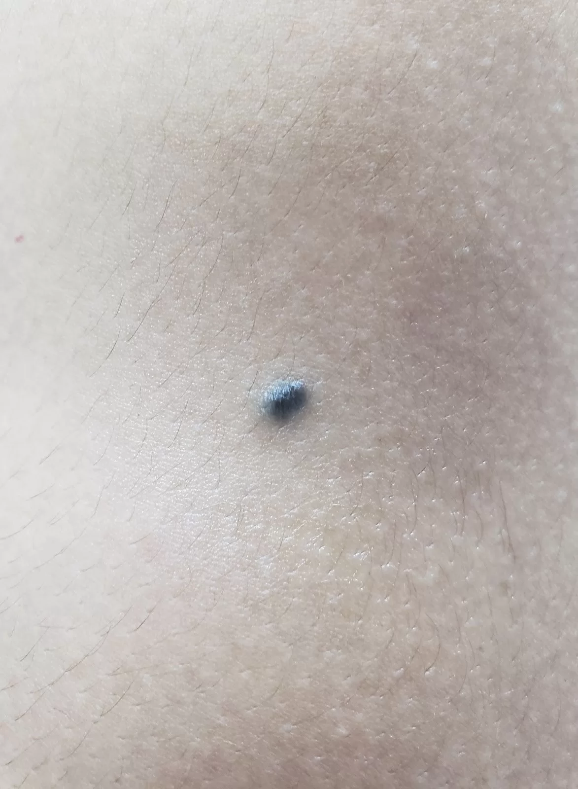 Você sabe o que são os nevos melanocíticos adquiridos? – ProntoPele